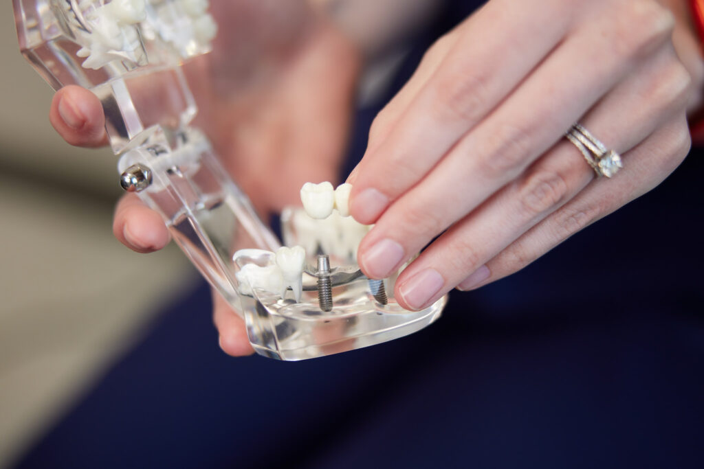 What is a Dental Bridge? | CarolinasDentist