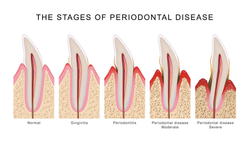 Signs That You Might Have Periodontitis | CarolinasDentist | North Carolina